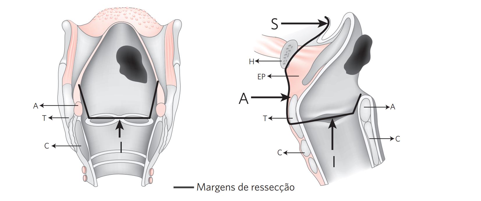 Cabeça e Pescoço – Carcinoma da laringe – (5ª edição – 2019 ...