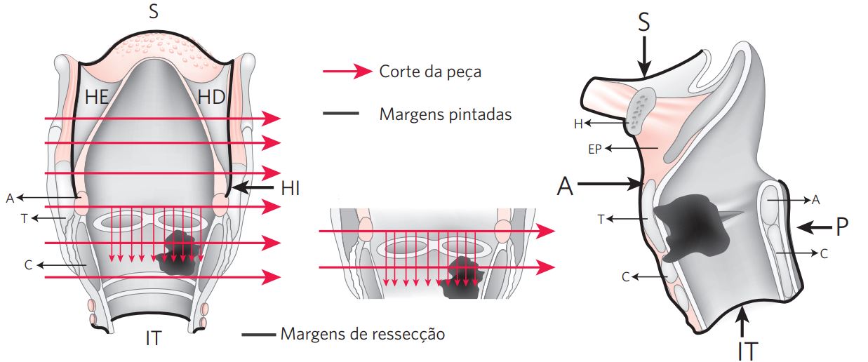 Cabeça e Pescoço – Carcinoma da laringe – (5ª edição – 2019 ...