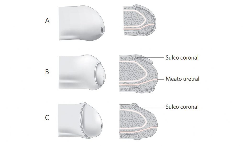 Pênis – Carcinoma – (5ª edição – 2019) | Sociedade Brasileira de Patologia