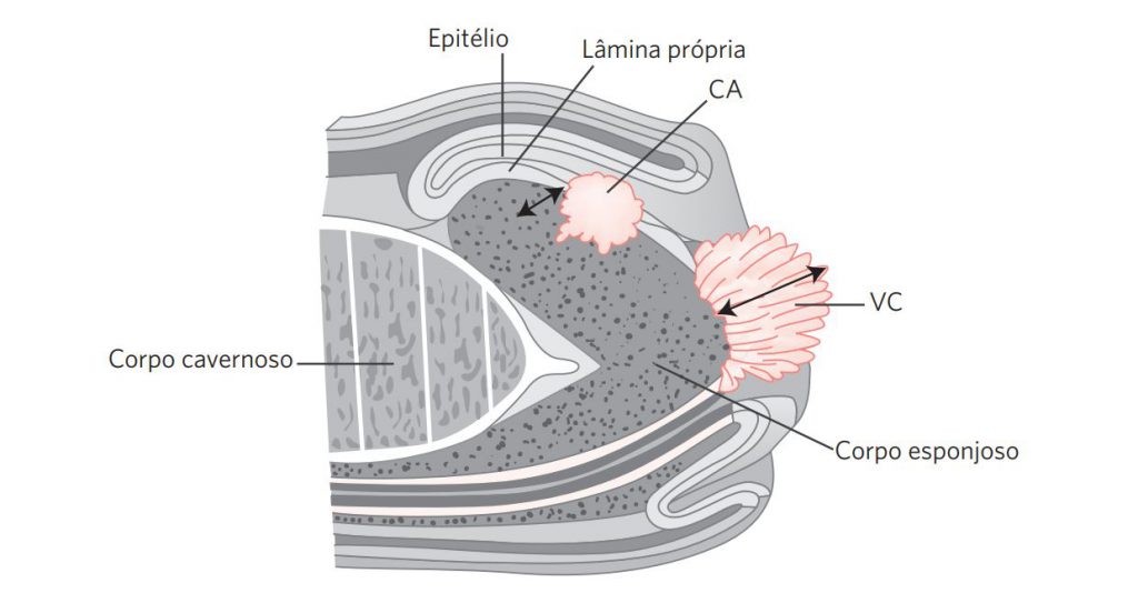 Pênis – Carcinoma – (5ª edição – 2019) | Sociedade Brasileira de Patologia