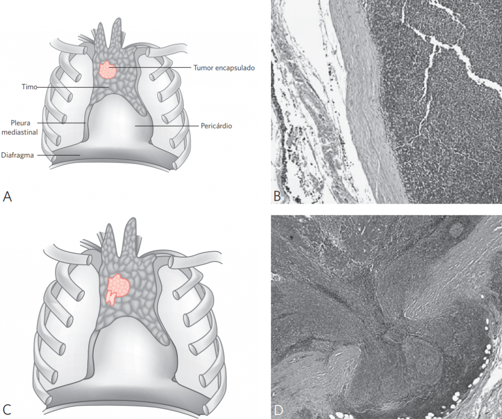 Timo – Tumores do timo – (5ª edição – 2019) | Sociedade Brasileira de ...