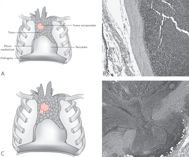 Timo – Tumores do timo – (5ª edição – 2019) | Sociedade Brasileira de ...