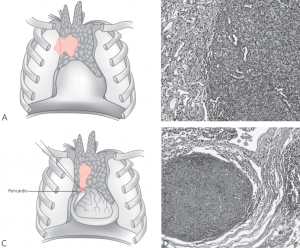 Timo – Tumores do timo – (5ª edição – 2019) | Sociedade Brasileira de ...