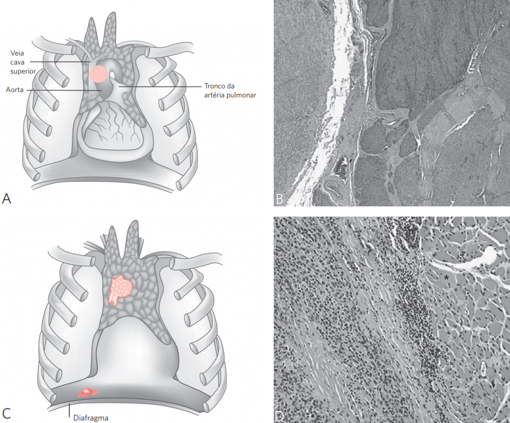 Timo – Tumores do timo – (5ª edição – 2019) | Sociedade Brasileira de ...