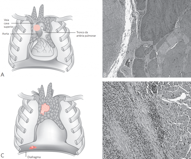Timo – Tumores do timo – (5ª edição – 2019) | Sociedade Brasileira de ...