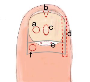 Patologia ungueal | Sociedade Brasileira de Patologia