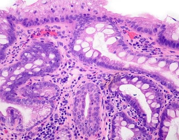 Esôfago | Sociedade Brasileira de Patologia